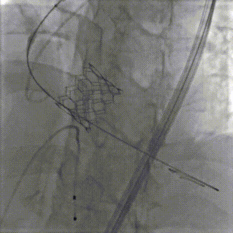 吉林省首例！吉林大学第一医院心血管内科团队应用SAPIEN 3¹瓣膜成功完成一例大瓣环Type0型二叶瓣TAVR手术_吉林大学白求恩第一医院